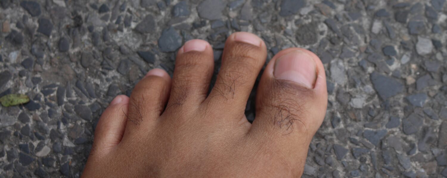 Surgery for Problems of the Small Toes - St Hugh’s